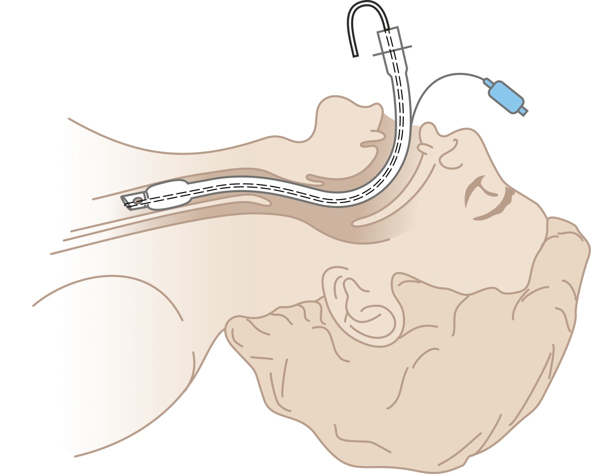 Endotracheal Tubes Indications Patient Management Video 55 OFF Endotracheal Tubes Indications Patient Management Video 55 OFF